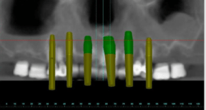 Guided Dental Implant Surgery, Surgical Stent for Dental implants