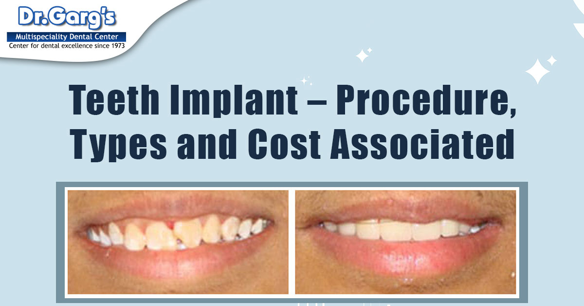Implant Teeth Procedure And Cost How Much Do Dental Implants Cost?